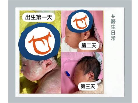 寶貝孫誕生竟「內建濟公帽」嬤嚇歪求救！醫笑曝真相：快拍照 Ettoday健康雲 Ettoday新聞雲