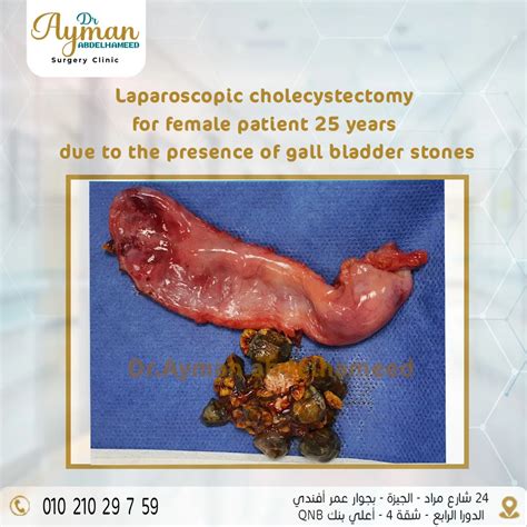 Laparoscopic Cholecystectomy Dr Ayman Abd Elha