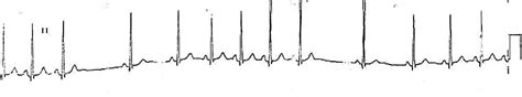 Sinoatrial Exit Block LITFL ECG Library Diagnosis