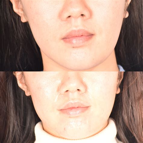 口角挙上モニターご紹介！ アネシス美容クリニックのブログ