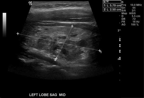 Thyroid Ultrasound