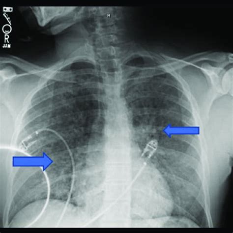 Blue Arrows Showed Diffuse Reticulonodular Opacities Download Scientific Diagram
