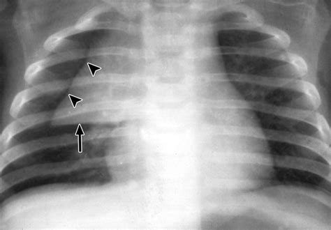 What Is A Thymic Shadow At Rosalie Kirby Blog
