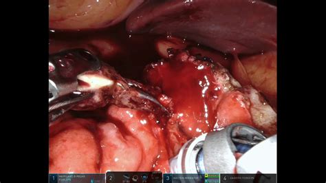 Robotic Removal Of Foreign Body From Duodenum Youtube