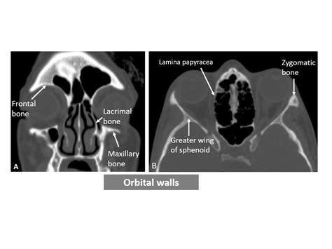 Greater Wing Of Sphenoid Radiograph