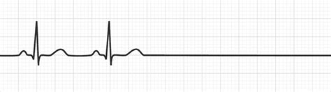 Sinus Arrest Bradyarrhythmias Medbabe