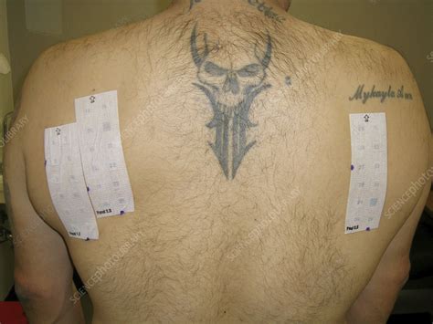 Allergy Patch Test Stock Image C060 8467 Science Photo Library