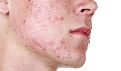 Acne Iscn