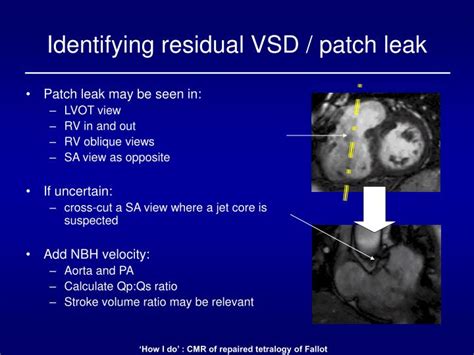 Ppt ‘how I Do Cmr Of Repaired Tetralogy Of Fallot Powerpoint