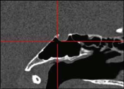 Complete Sellar Type Pneumatization Of The Sphenoid Sinus Download Scientific Diagram