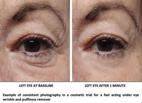 Before And After Photos In Cosmetic Trials Ozderm