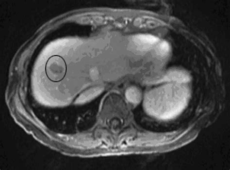 Hypervascular Liver Lesions On Mri Ajr