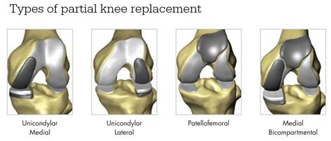 Partial Knee Replacement