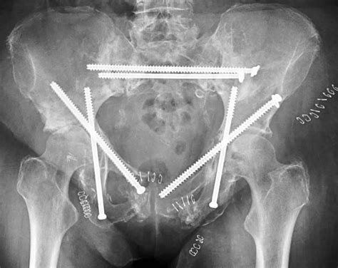 Percutaneous Pelvic Ring Fixation In Older Adults