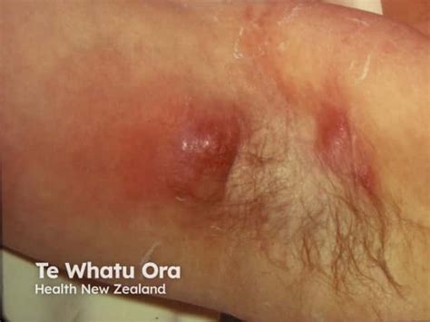 Live Abscess