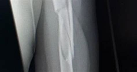 Broken Humerus Owie Imgur