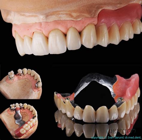 Prosthetics Identic