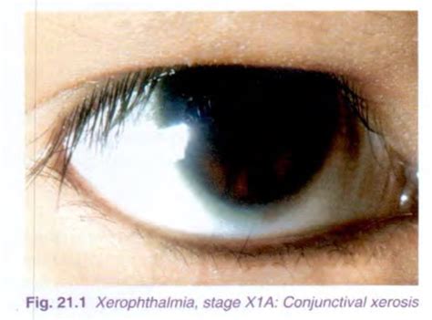 Conjunctival Xerosis