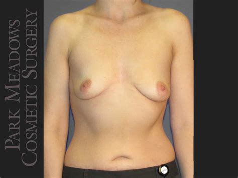 Silicone Breast Augmentation Park Meadows Cosmetic Surgery