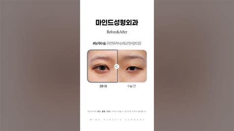 눈재수술 짝눈교정 앞트임 3주차 변화 마인드성형외과 Youtube