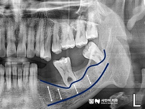 천안 임플란트 치과 가 강조하는 잇몸의 중요성 네이버 블로그