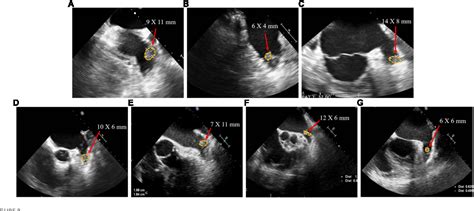 Figure 2 From Percutaneous Left Atrial Appendage Closure Using The