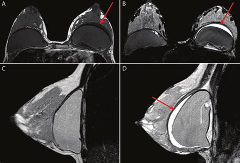 Magnetic Resonance Imaging Of The Breasts Arrows Indicate The