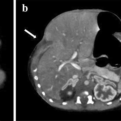 Patient 2 Ct Angiography In A 3 Day Old Girl With Ectopia Cordis And Download Scientific