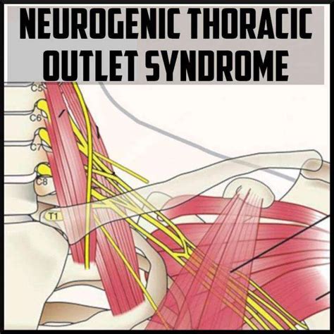 Neurogenic Thoracic Outlet Syndrome Sports Med Review