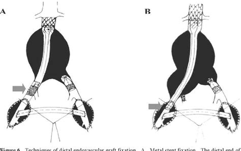 Figure 6 From A Comparison Of Distal Endoluminal Graft Fixation Methods Healing Characteristics