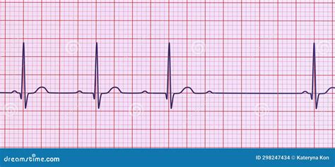 An Ecg With 2nd Degree Av Block 3d Illustration Stock Illustration
