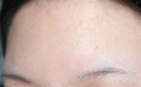 都在推爆的水杨酸好用吗连续用14天使用粉刺闭口会消退吗 知乎