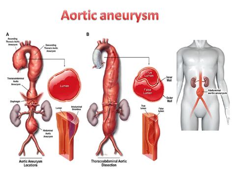 Fusiform Ectasia Of Abdominal Aorta