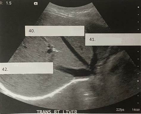 Vascular Previous Quizexam Questions Flashcards Quizlet