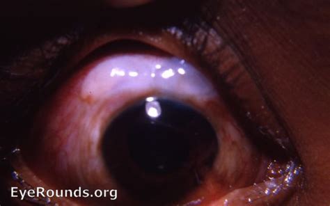 Succulent Filtering Bleb Following Glaucoma Surgery Online Ophthalmic Atlas