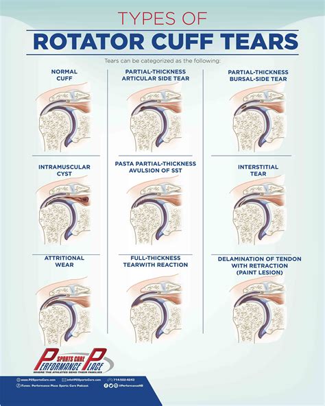 Rotator Cuff Tear Grade 1 At Arthur Snipes Blog