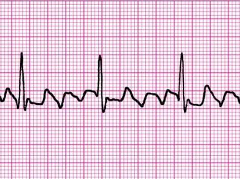 Atrial Flutter Ablation At Dr Karthigesan Clinic Chennai