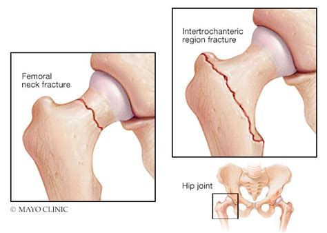 Classification Of Hip Fractures 1 Femoral Neck