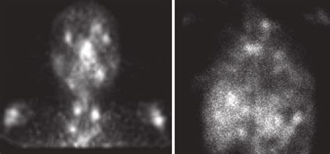 Spect Gallium Scan Displaying Increased Radiotracer Activity A In The