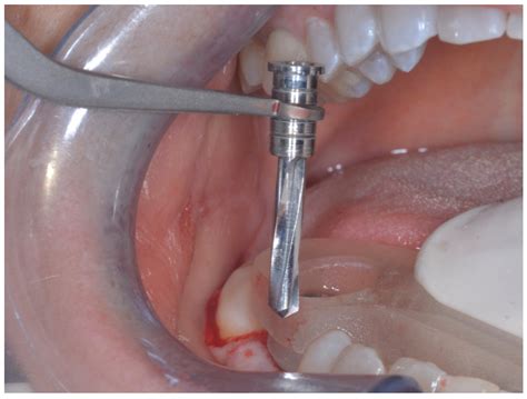 A Novel Approach To Guided Implant Surgery A Technical Note