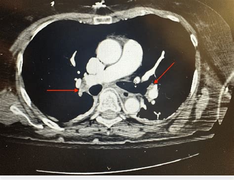 Postoperative Ct Angiogram Of The Chest The Image Demonstrated Download Scientific Diagram