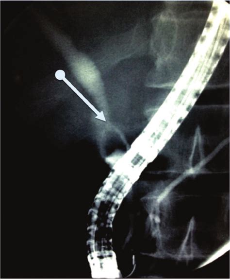 Endoscopic Retrograde Cholangiopancreatography The Arrow Indicates A