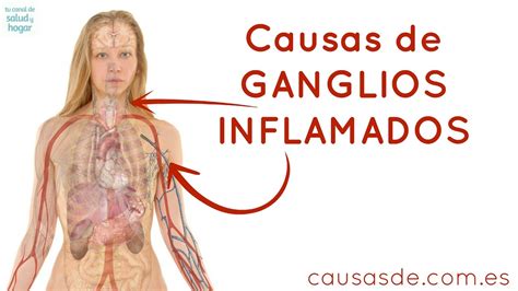Ganglios Linfáticos Inflamados Que Son Causas Y Tratamiento Wcypm