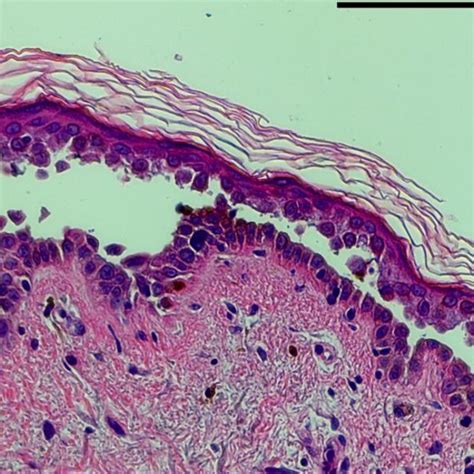 Histopathology Shows The Characteristic Tombstone Pattern Resulting Download Scientific Diagram