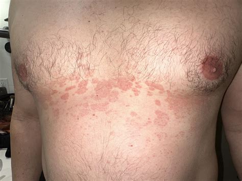 Chronic Rash Rdermatologyquestions