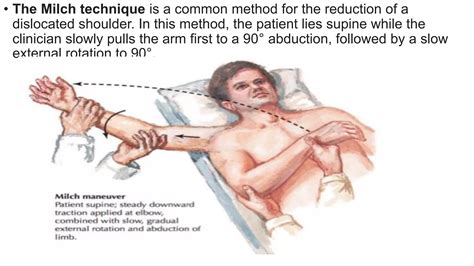 Shoulder Dislocation Pptx