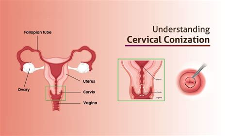 What Is Cone Biopsy Hill Regional Hospital