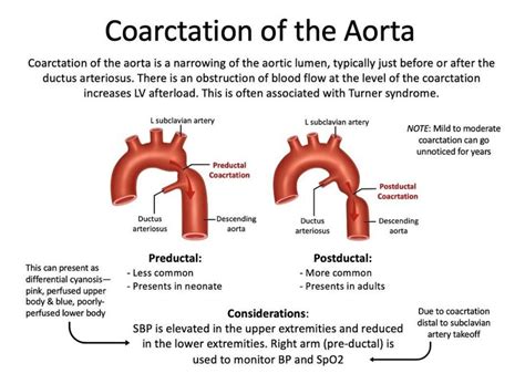Coarctation Of Aorta Medizzy