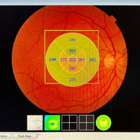 The 3d Macula Report Protocol Download Scientific Diagram
