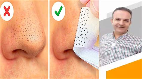 سریع ترین راه درمان جوش سرسیاه 👌 از بین بردن جوش سرسیاه بینی و صورت با 2 ماسک خانگی دکتر